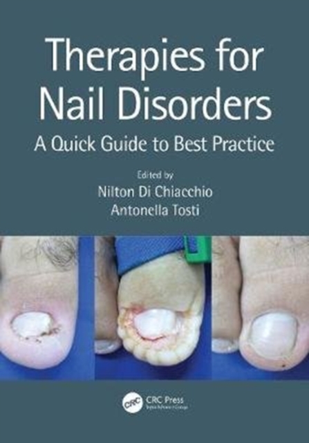 Therapies for Nail Disorders : A Quick Guide to Best Practice ...