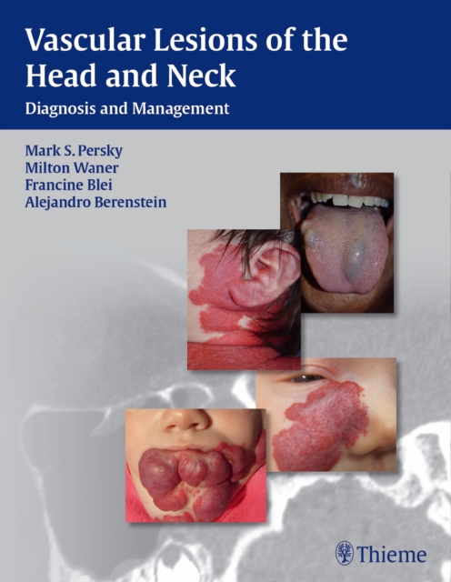 Vascular Lesions of the Head and Neck : Diagnosis and Management ...