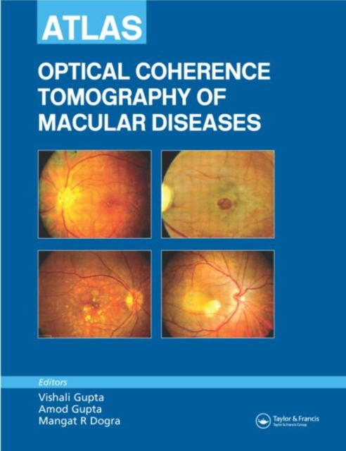 Atlas of Optical Coherence Tomography of Macular Diseases: Vishali ...