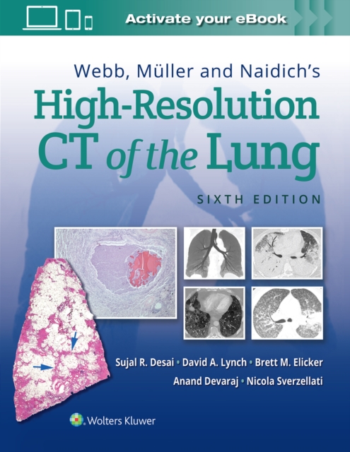 Webb, Muller and Naidich's High-Resolution CT of the Lung: Sujal Desai ...